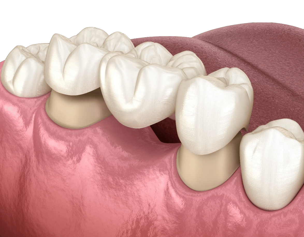 Prothèses et dentiers Lausanne | Dentiste Lausanne Dr Naharro